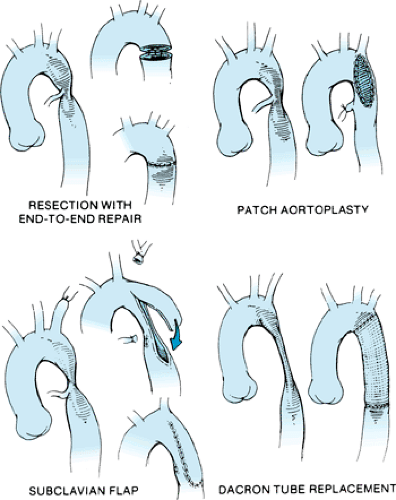 Coarctation of the Aorta | Musculoskeletal Key
