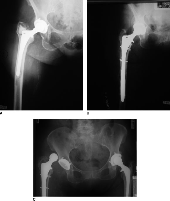 Extensively Porous-Coated Stems | Musculoskeletal Key