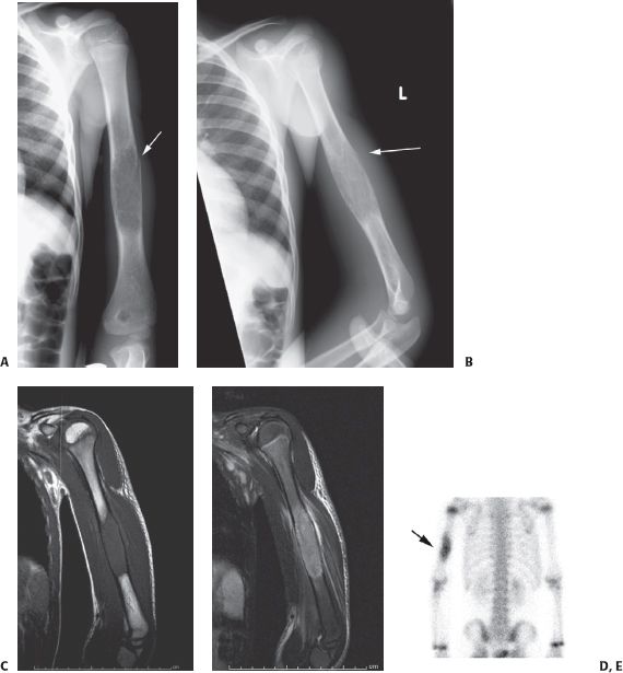 Pathologic Fractures | Musculoskeletal Key