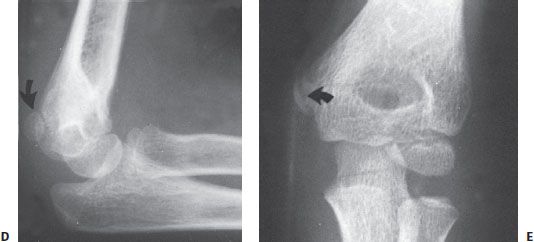 Dislocations of the Elbows, Medial Epicondylar Humerus Fractures ...