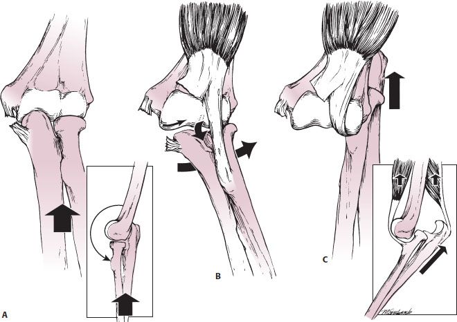 Dislocations of the Elbows, Medial Epicondylar Humerus Fractures ...