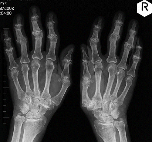 Osteoarthritis | Musculoskeletal Key