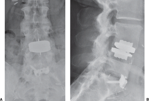 Cervical and Lumbar Arthroplasty, Interspinous Devices, and Motion ...
