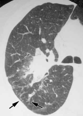 chest | Radiology Notes | Page 5