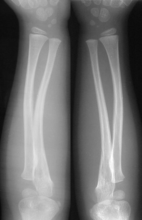 Bowing deformity | Radiology Notes