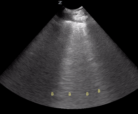 b-lines-annotated – NephroPOCUS
