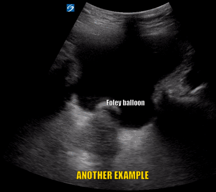bladder-foley-annotated – NephroPOCUS