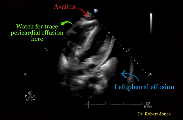 Fluid in the subcostal cardiac view – NephroPOCUS