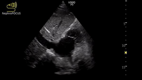 The subcostal bicaval view – NephroPOCUS