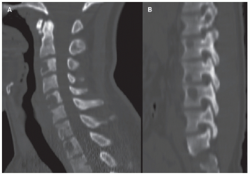 Cervical Spinal Infections | Neupsy Key