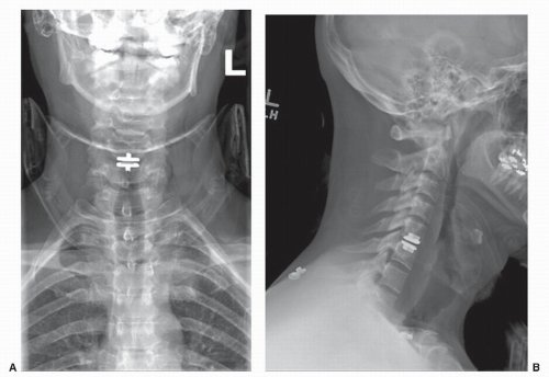 Cervical Degenerative Disk Disease: Overview and Epidemiology | Neupsy Key