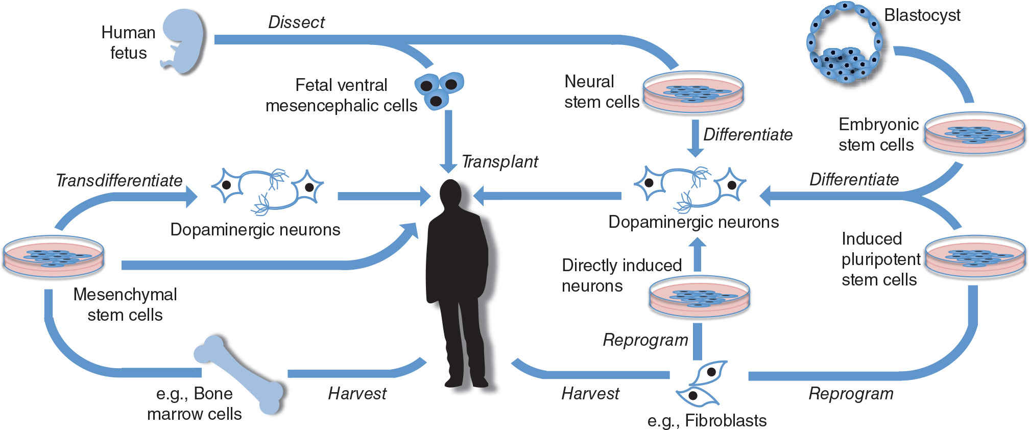 Cell-Based Therapy for Parkinson’s Disease | Neupsy Key