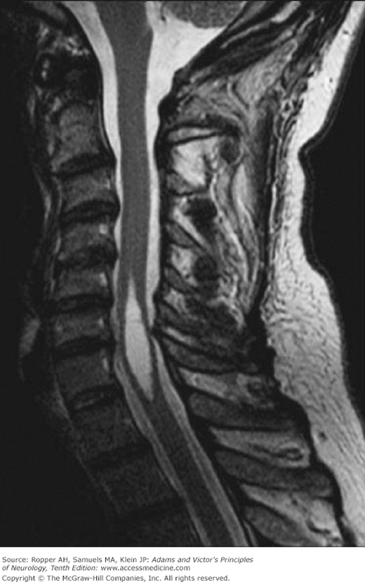 Chapter 44. Diseases of the Spinal Cord | Neupsy Key