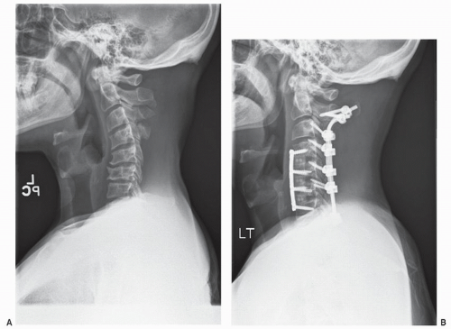 Cervical Deformity | Neupsy Key