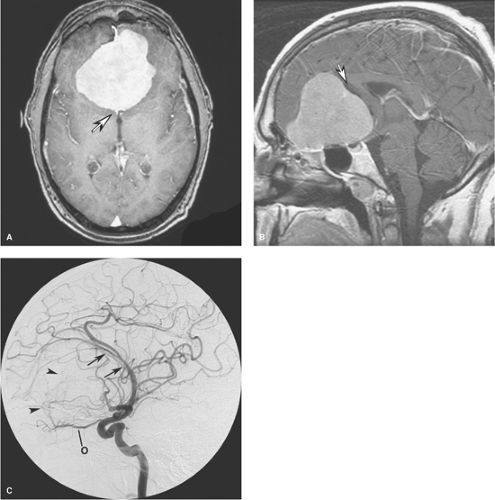 The Anterior Cerebral Artery | Neupsy Key