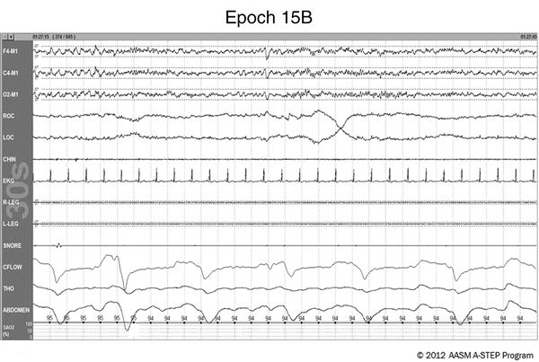 Adult Sleep Scoring | Neupsy Key