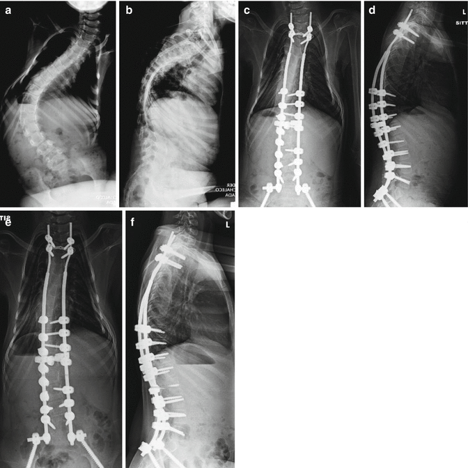 Other Neuromuscular Diseases | Neupsy Key