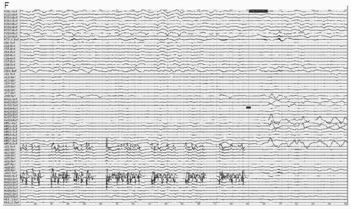 Intracranial Monitoring: Depth, Subdural, and Foramen Ovale Electrodes ...