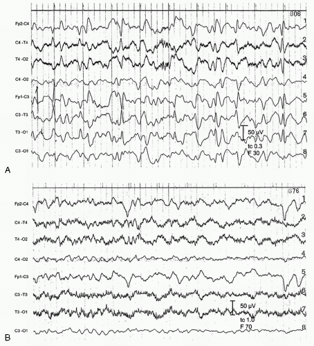 EEG, Drug Effects, and Central Nervous System Poisoning | Neupsy Key