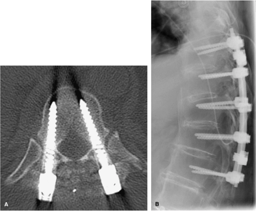 Surgical Treatment of Spinal Injury | Neupsy Key