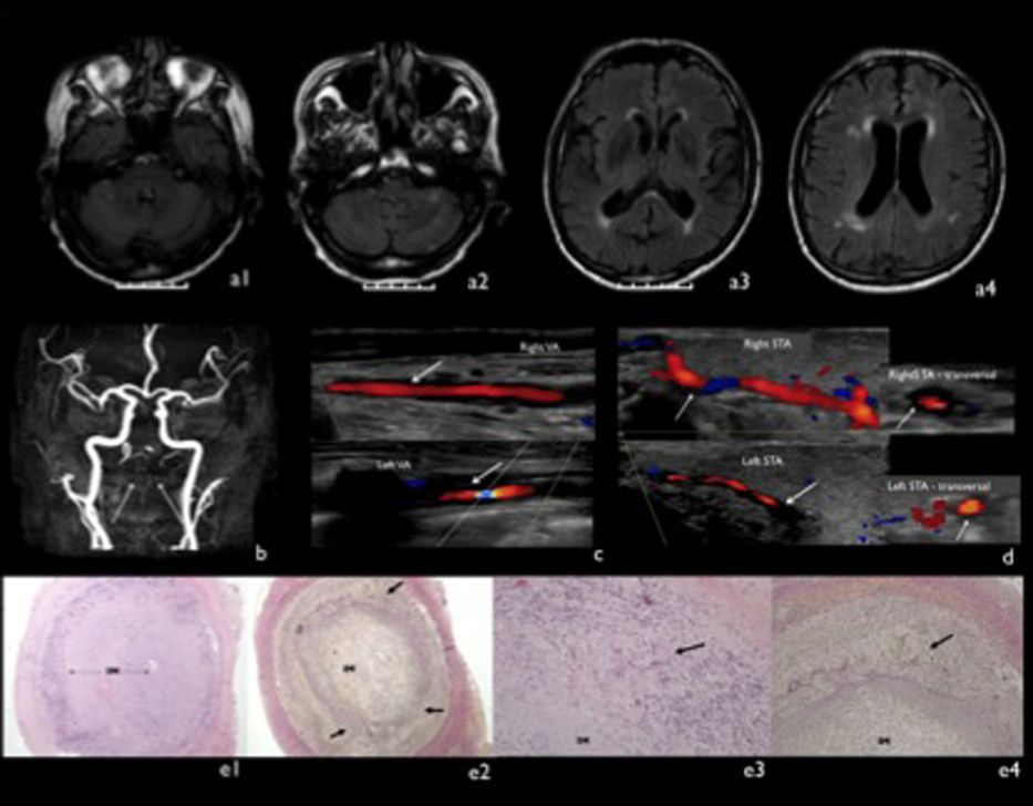 The diagnosis and overdiagnosis of cerebral vasculitis | Neupsy Key