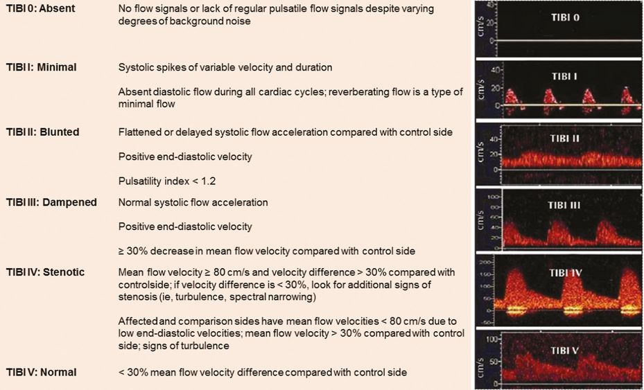 Sonothrombolysis | Neupsy Key