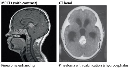 INTRACRANIAL TUMOURS | Neupsy Key