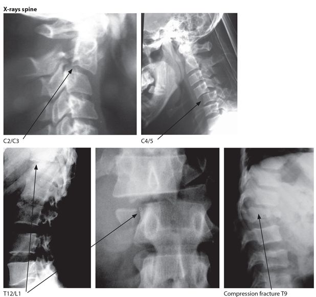 HEAD AND SPINAL INJURY | Neupsy Key