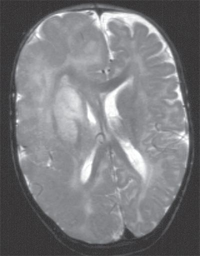 Epileptic Auras | Neupsy Key