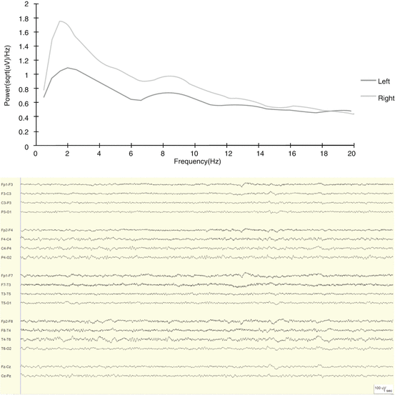 Quantitative EEG Analysis: Basics | Neupsy Key