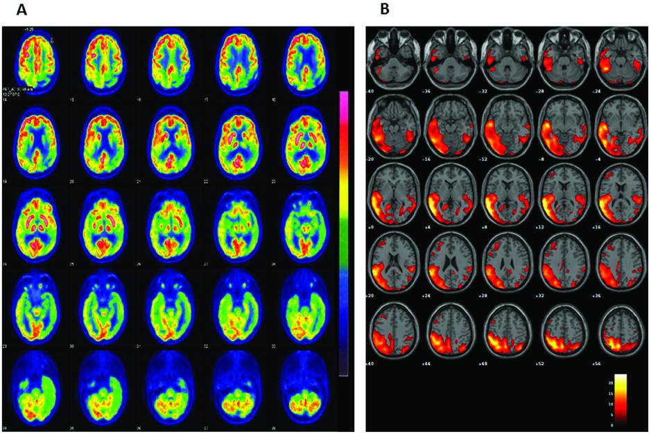 Primary progressive aphasia | Neupsy Key