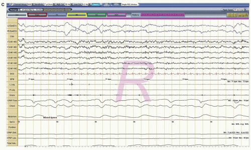 Introduction to Sleep and Polysomnography | Neupsy Key