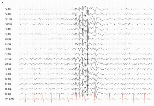 Epileptiform Activity, Seizures, and Epilepsy Syndromes | Neupsy Key