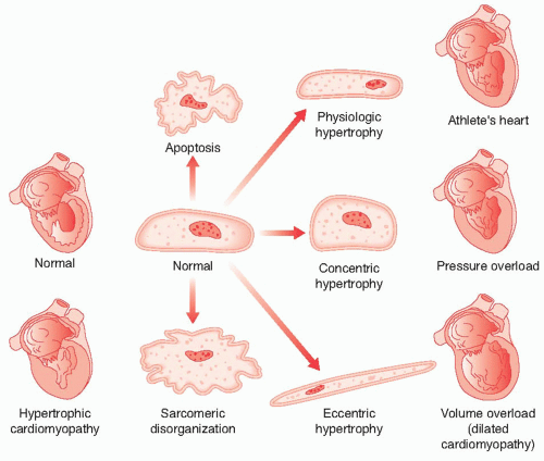 Heart Failure and Cardiogenic Shock | Nurse Key