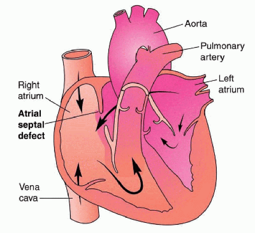 Cardiac Disorders | Nurse Key