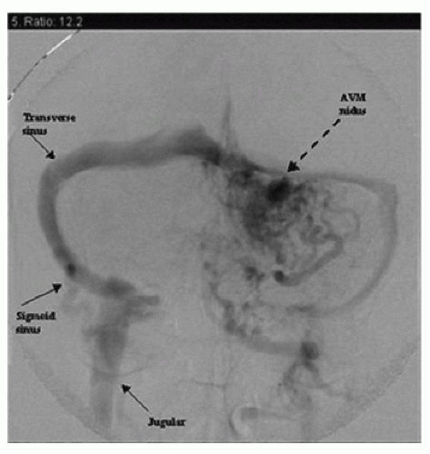 Neurologic Disorders | Nurse Key