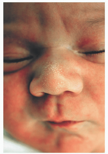 Dermatologic Conditions in Children | Nurse Key