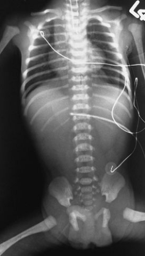 Esophageal Atresia and Tracheoesophageal Fistula | Obgyn Key