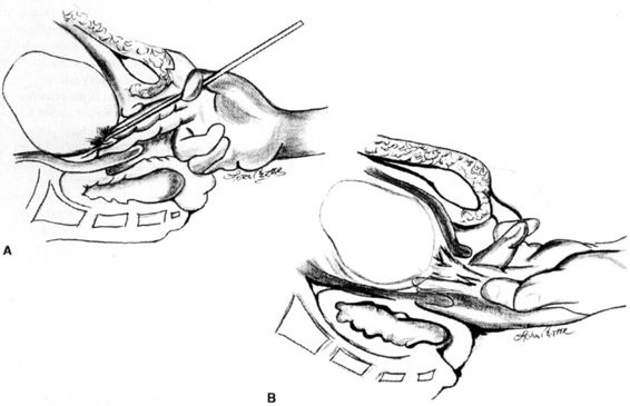 Cervical Ripening and Induction of Labor | Obgyn Key