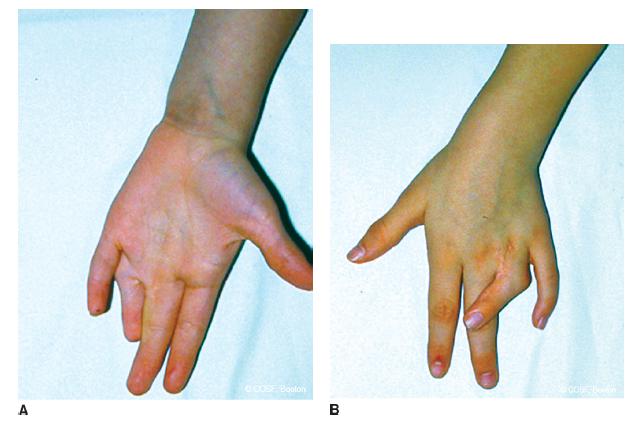 Central Polydactyly | Obgyn Key