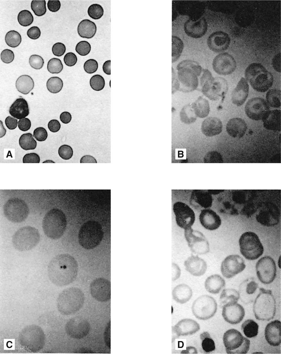 and Neoplastic Diseases | Obgyn Key