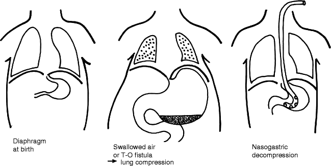 Respiratory Distress in the Newborn | Obgyn Key