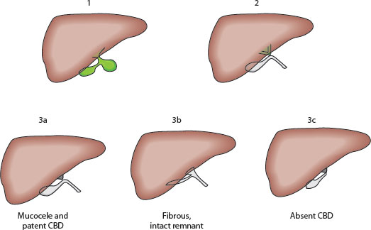 Biliary atresia | Obgyn Key