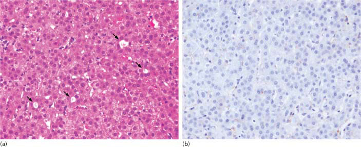 Liver pathology | Obgyn Key