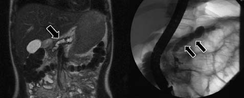 Chronic pancreatitis | Obgyn Key