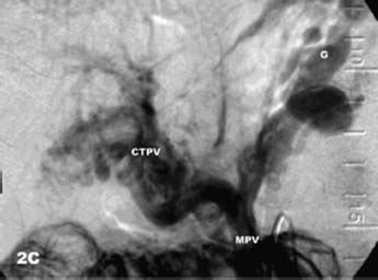 The meso-Rex shunt | Obgyn Key