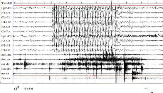 Age: Epilepsy With Myoclonic Absences and Epilepsy With Eyelid ...