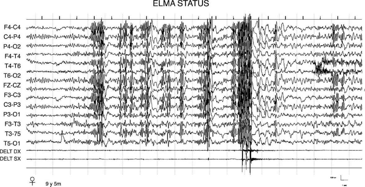 Age: Epilepsy With Myoclonic Absences and Epilepsy With Eyelid ...