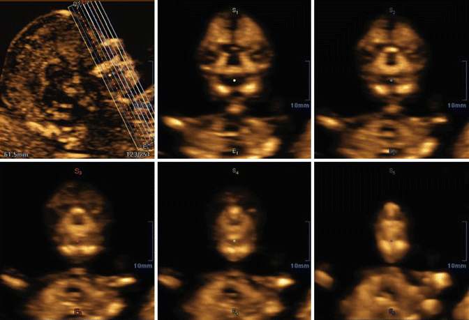 Evaluation of the Fetal Face in the First Trimester | Obgyn Key