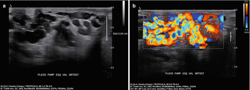 Non-obstructive Diseases of the Testes | Obgyn Key